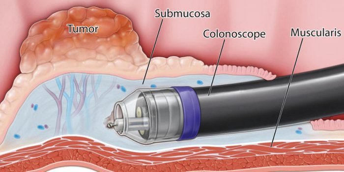 Επεμβατικός Γαστρεντερολόγος - Γιώργος Μαυρογένης POEM, ESD